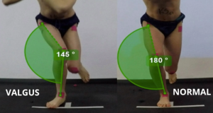 How to Check Knock Knees for Indian Army SSB?